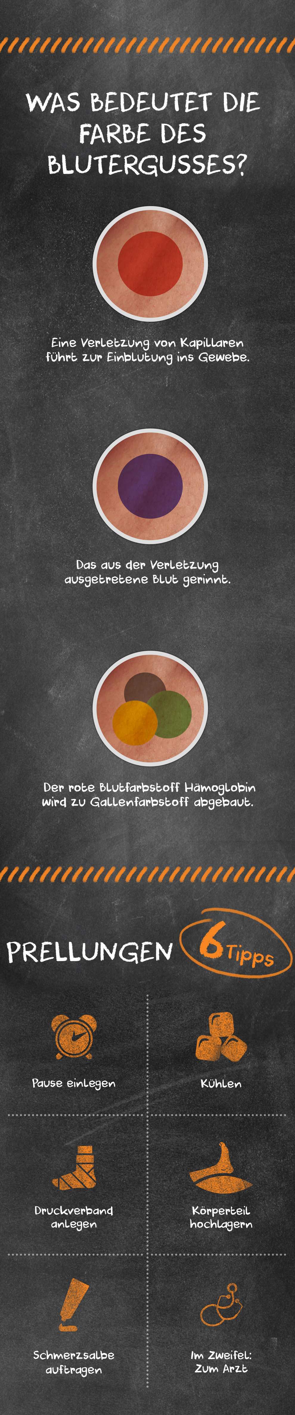 prellungen-infografik | Prellung